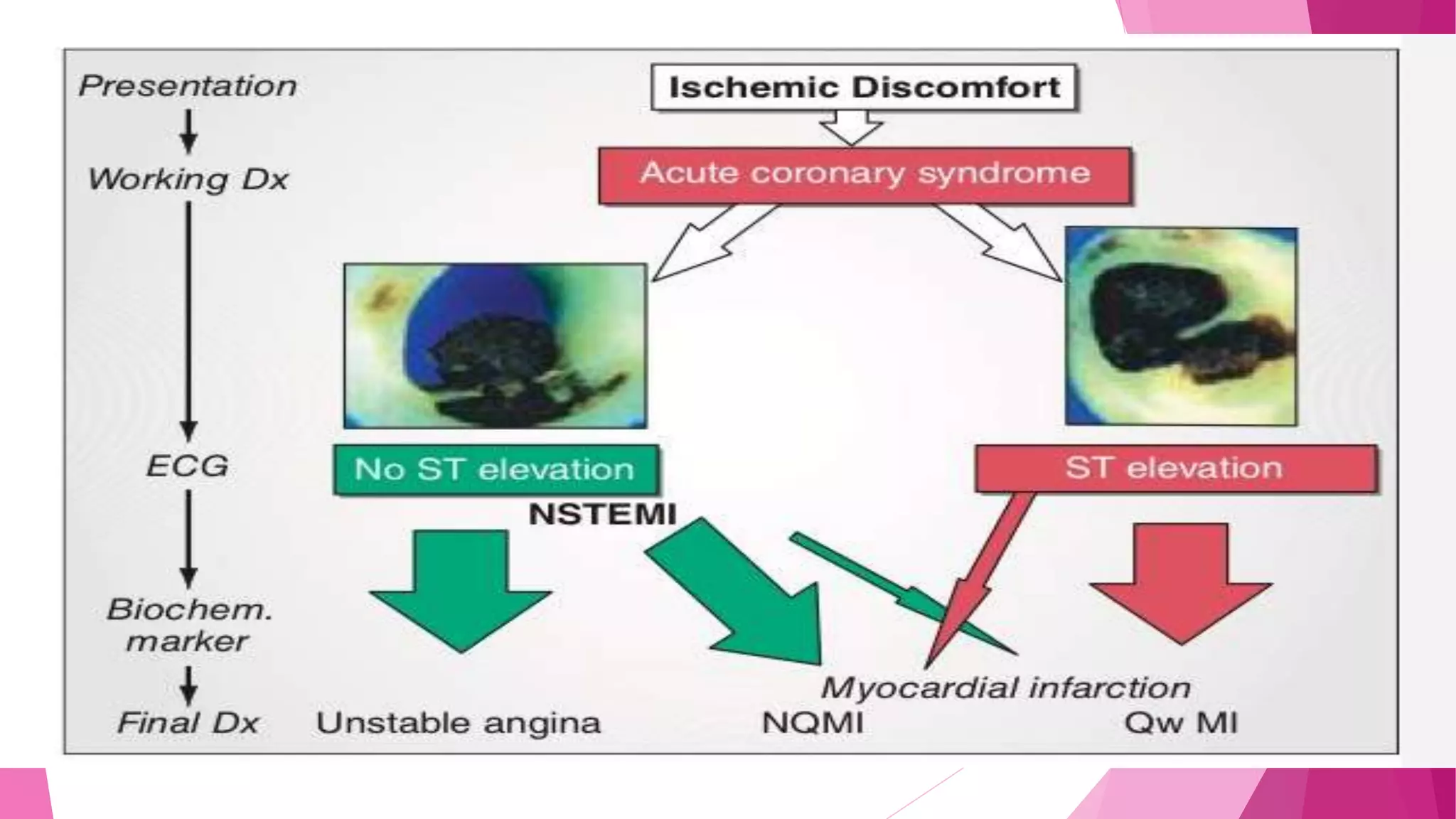 Acute coronary syndrome (acs) | PPTX | Heart and Cardiovascular ...