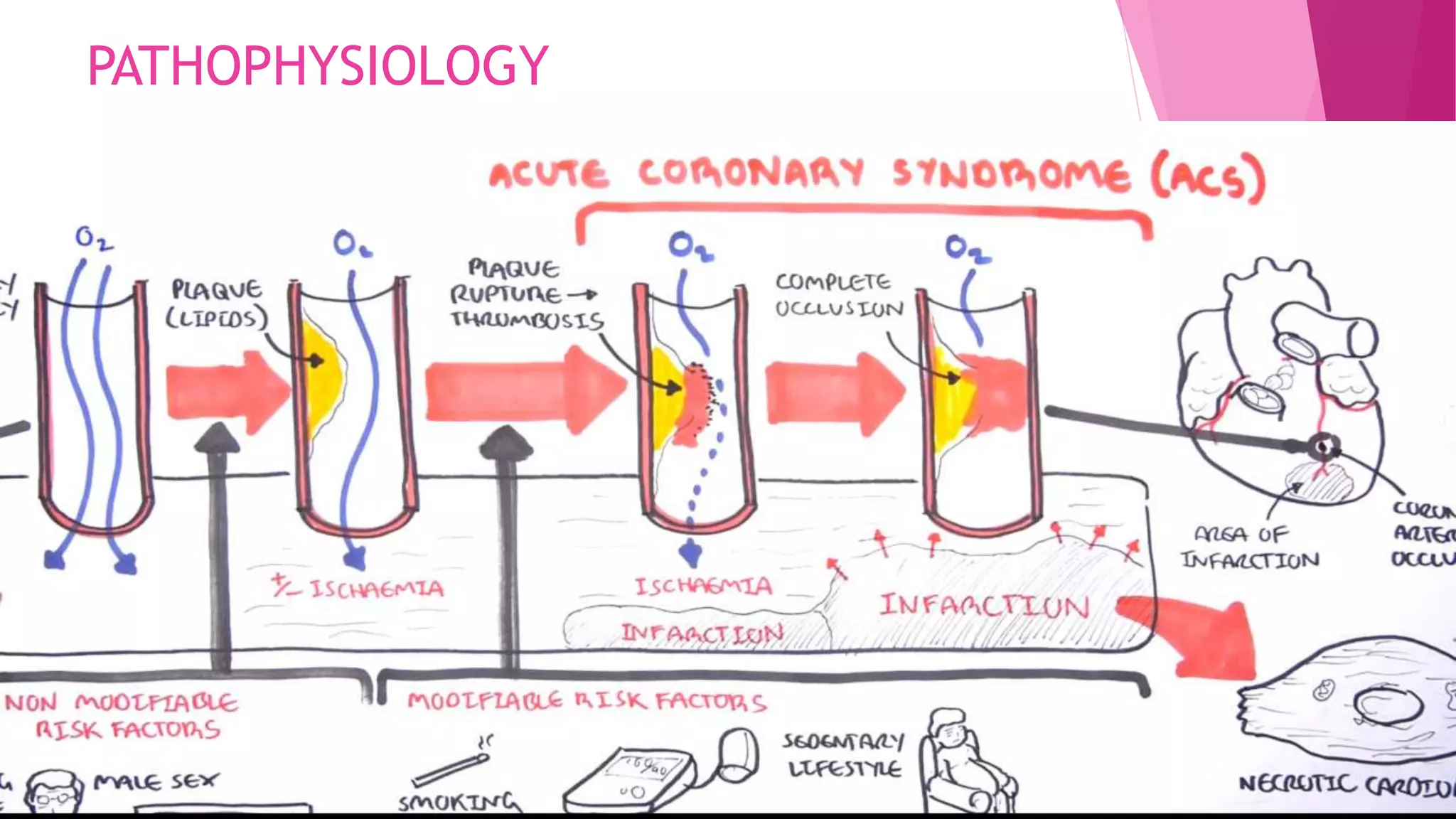 Acute coronary syndrome (acs) | PPTX | Heart and Cardiovascular ...