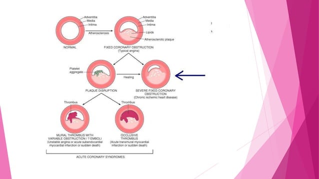 Acute coronary syndrome (acs) | PPTX | Heart and Cardiovascular ...