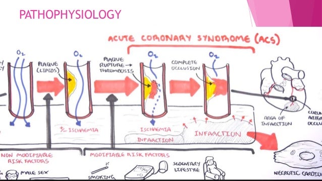 Acute coronary syndrome (acs)
