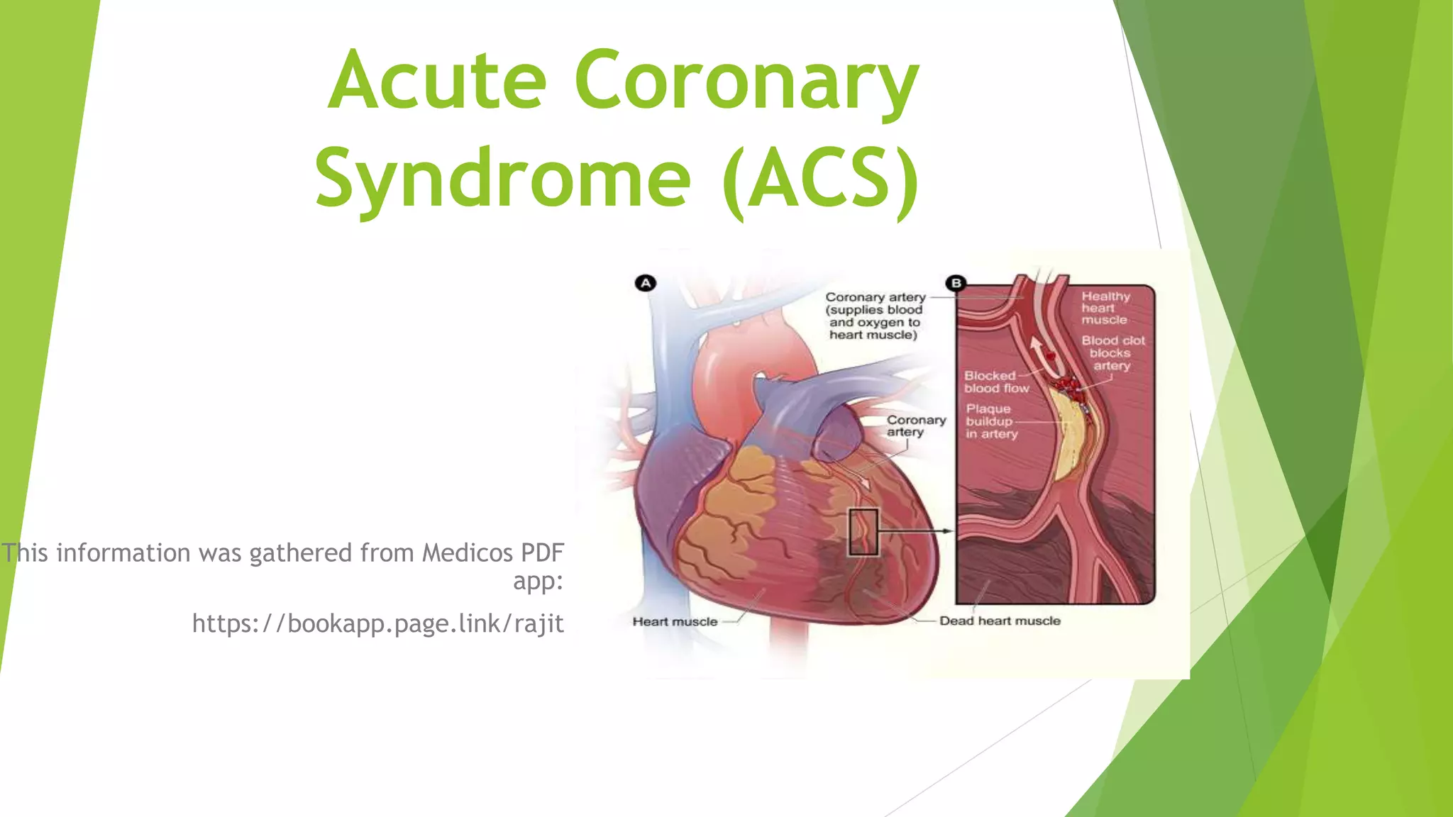 Acute coronary syndrome (acs) | PPT