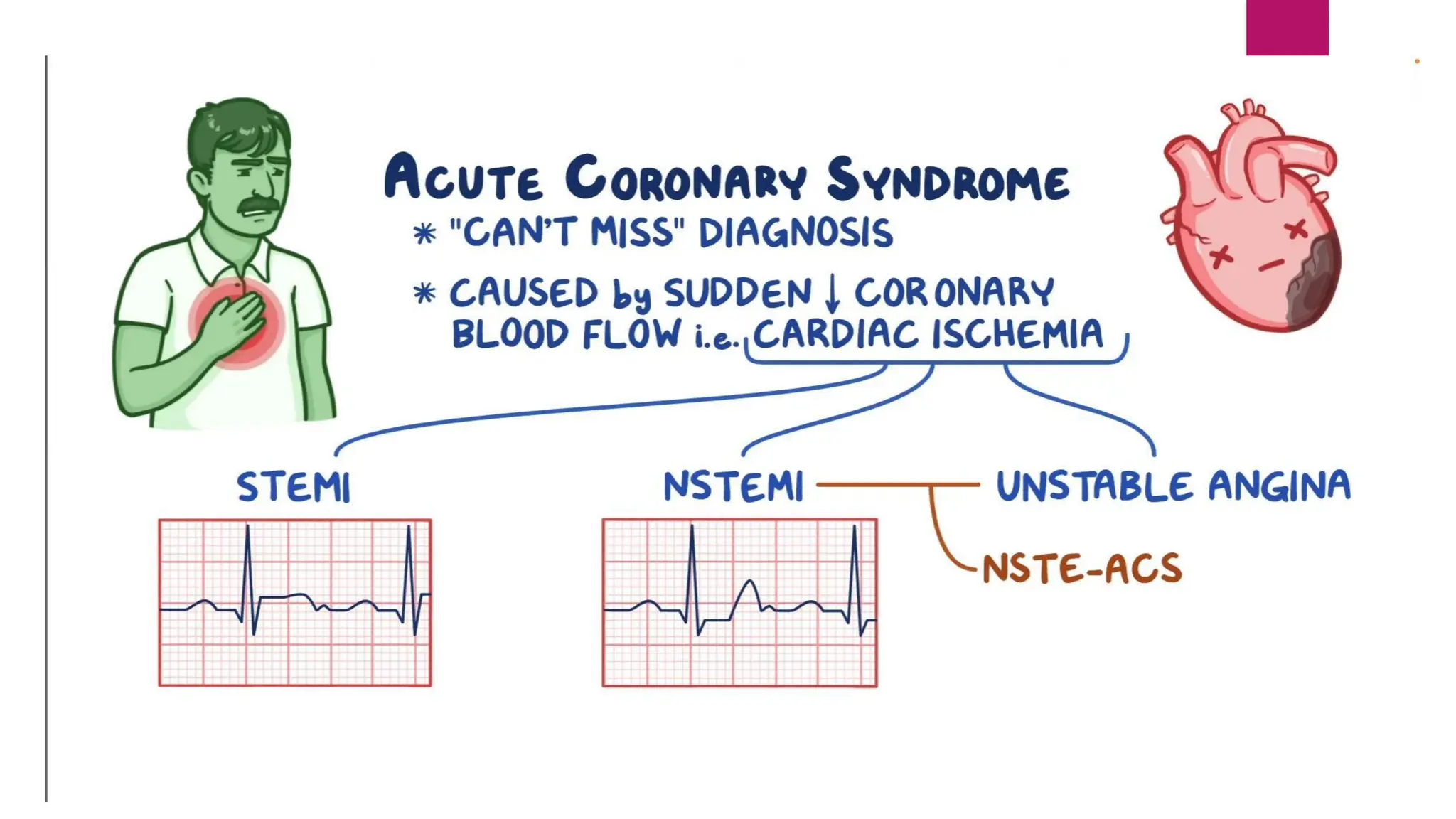 Acute Coronary Syndrome(MI).pdf