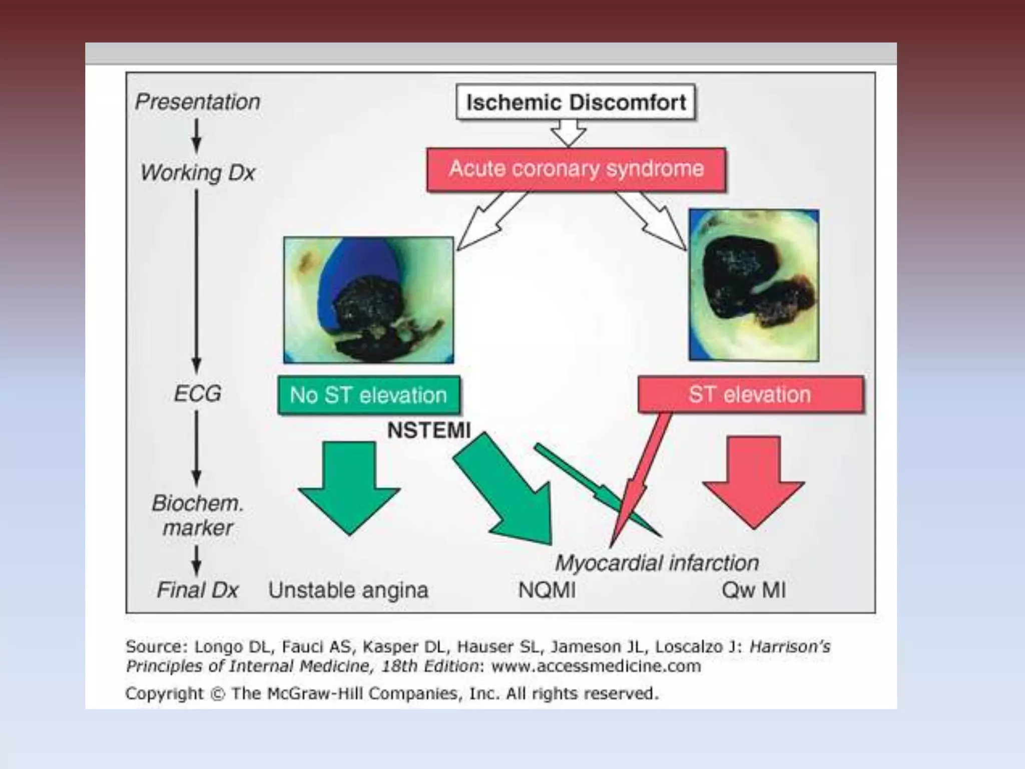 Acute coronary syndrome NSTEMI | PPTX
