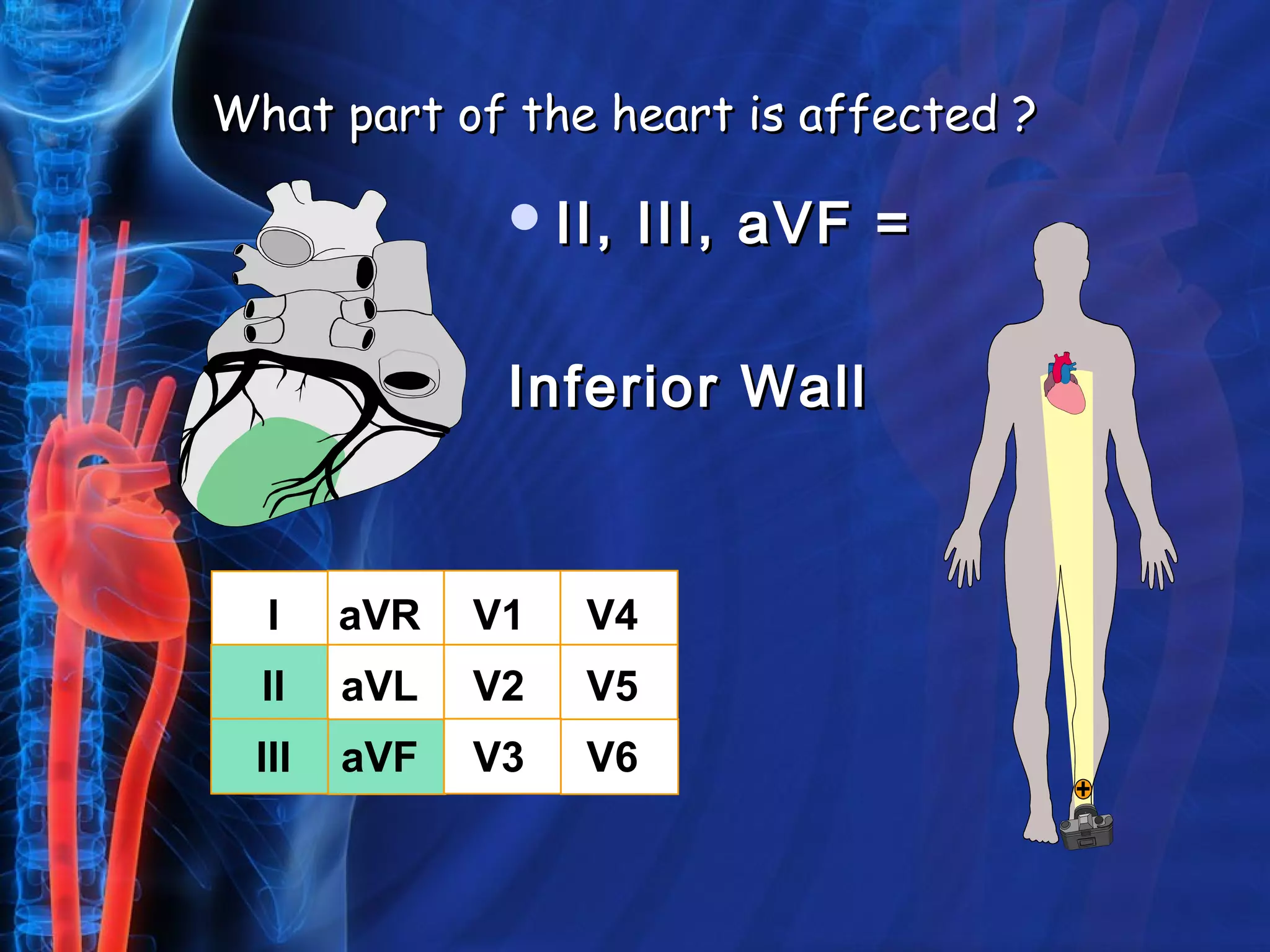 Acute coronary syndrome presentation with bivalirudin | PPT