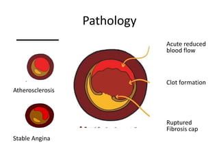 Acute Coronary Syndroms (ACS) by Feroz Khan RN.pptx