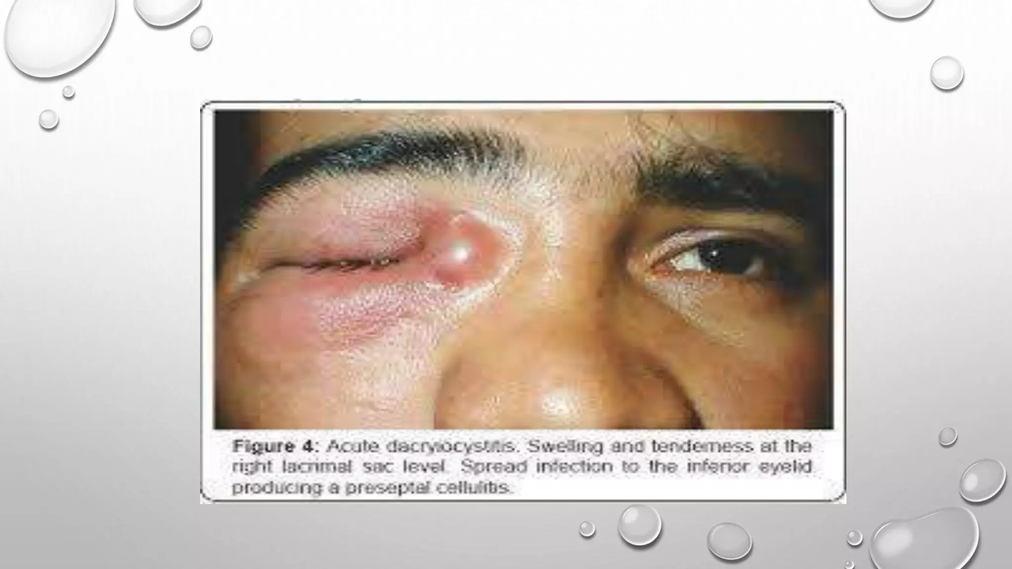 Acute dacryocystisis | PPTX