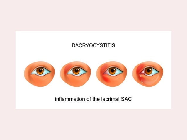 Acute Dacryocystitis quick Review | PPT
