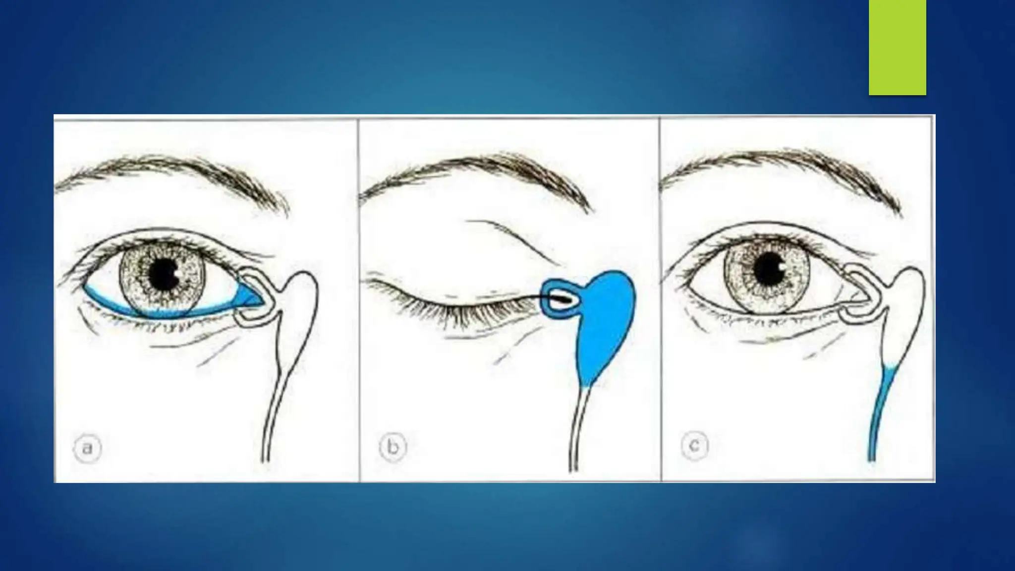 Acute Dacryocystitis | PPTX