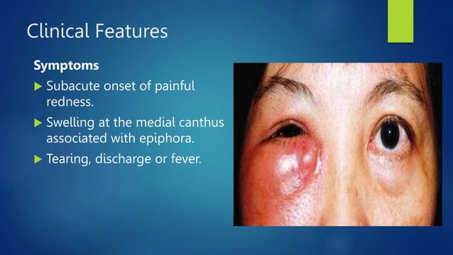 Acute Dacryocystitis | PPT