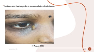 acute dacryocystitis 2.pptx with details | PPT