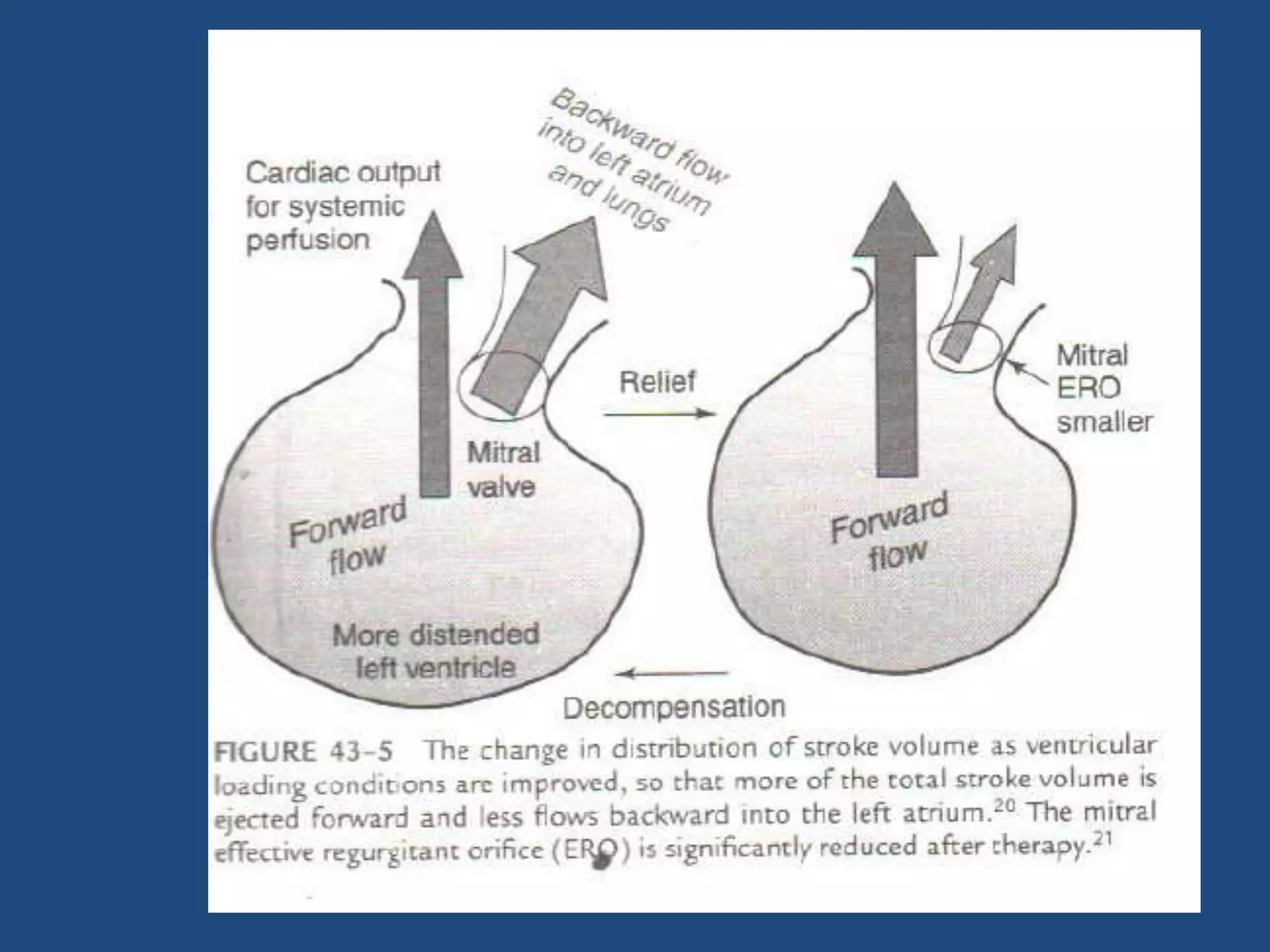 Acute decompensated heart failure | PPTX