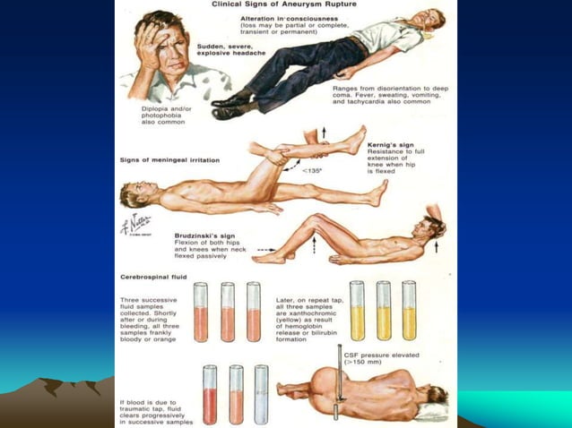 acute disorders of cerebral circulation.ppt | Brain and Nervous System ...