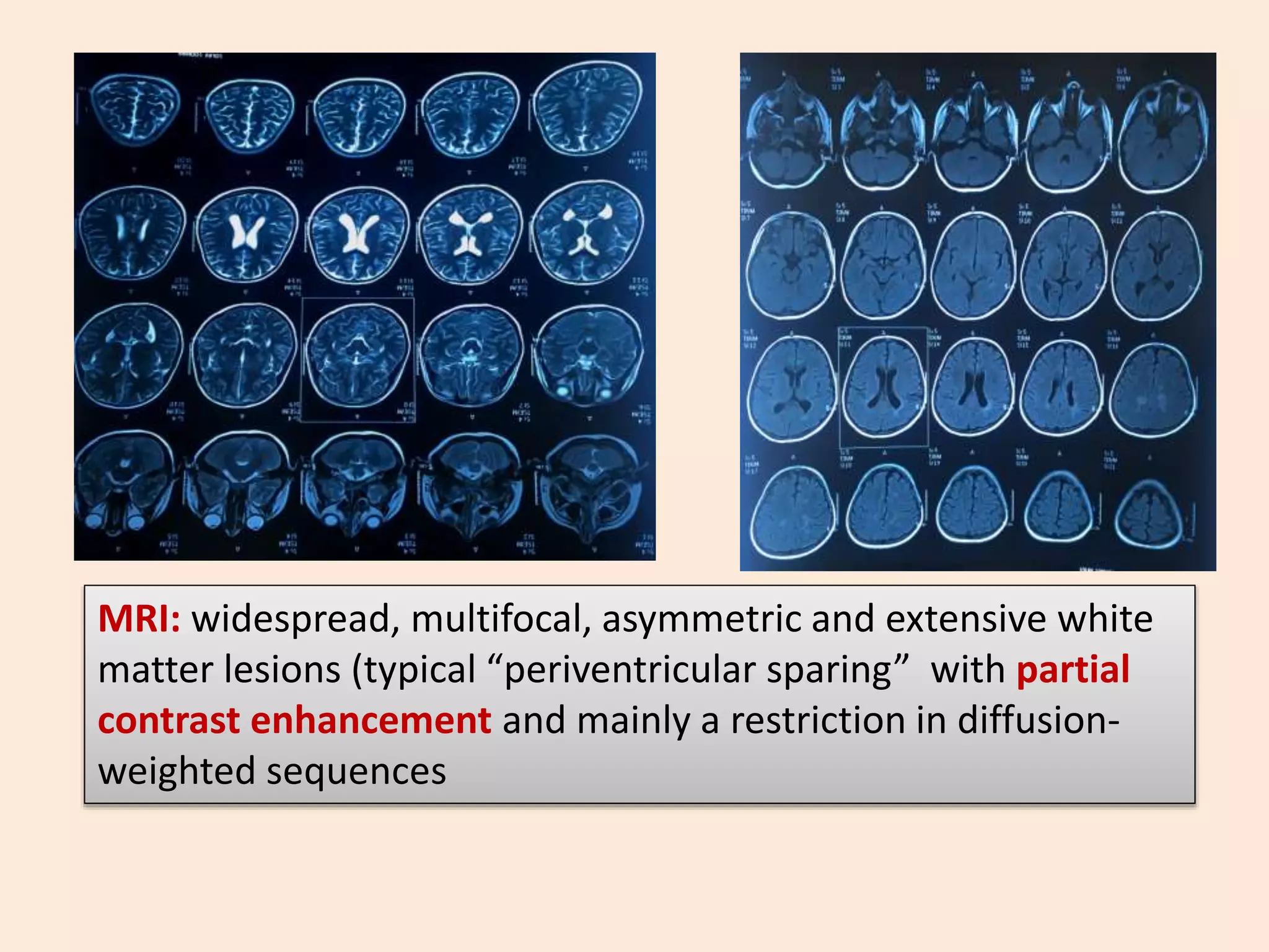 Acute disseminated encephalomyelitis (ADEM) .Case Report. | PPTX
