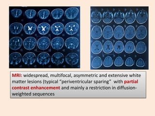 Acute disseminated encephalomyelitis (ADEM) .Case Report. | PPTX ...