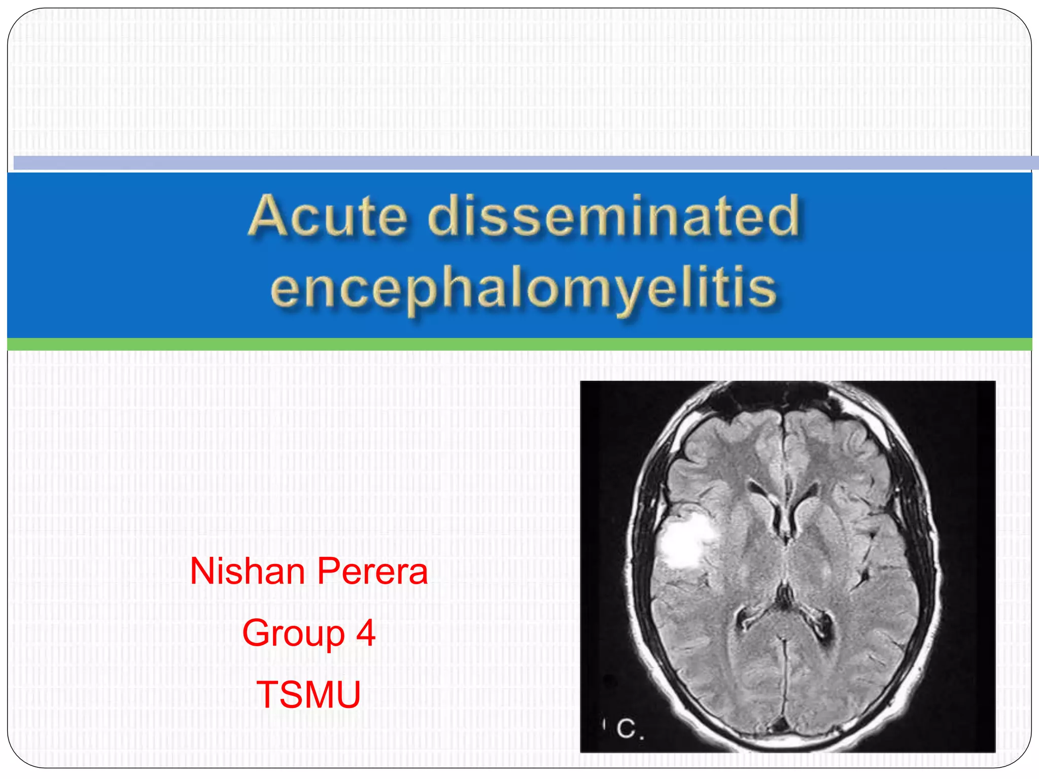 Acute Disseminated Encephalomyelitis | PPTX