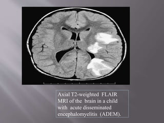 Acute Disseminated Encephalomyelitis | PPTX