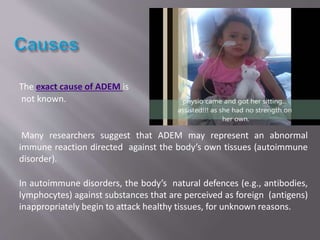 Acute Disseminated Encephalomyelitis | PPTX