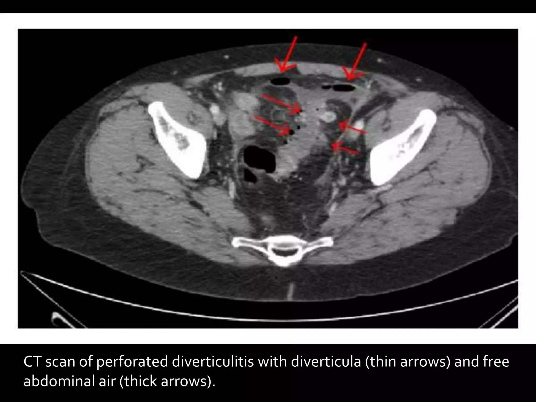Imaging of Acute Diverticulitis | PPTX