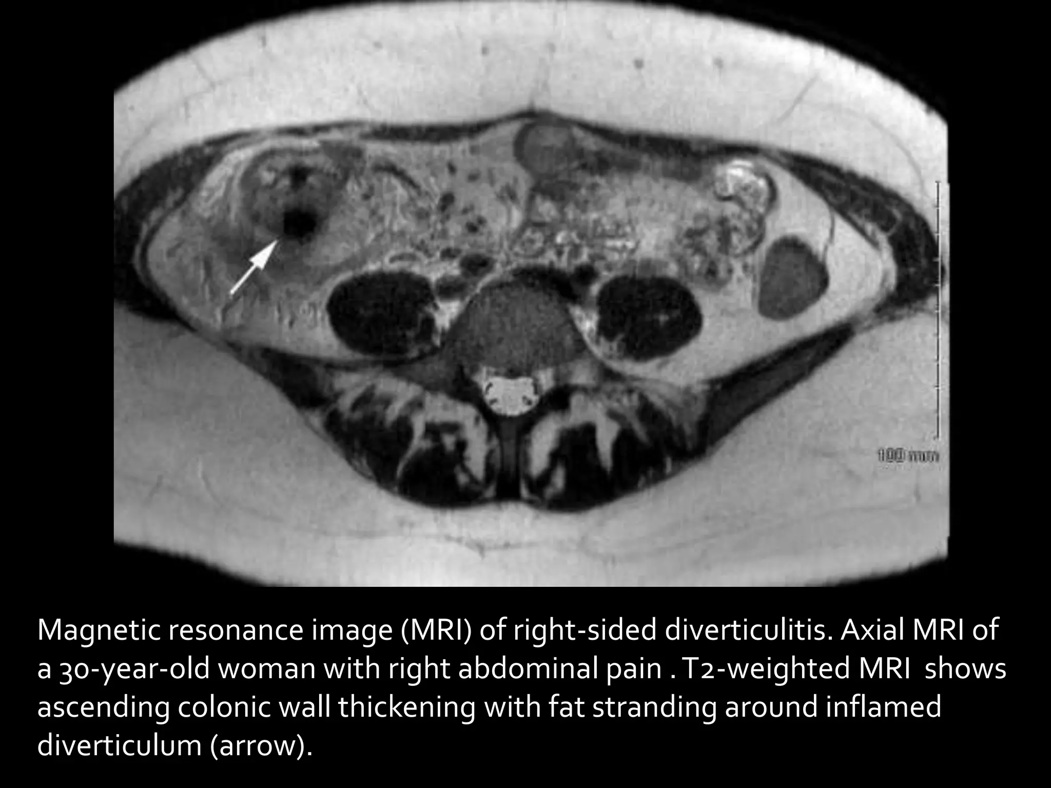 Imaging of Acute Diverticulitis | PPTX