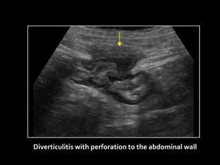 Imaging of Acute Diverticulitis | PPTX