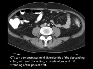 Imaging of Acute Diverticulitis | PPTX
