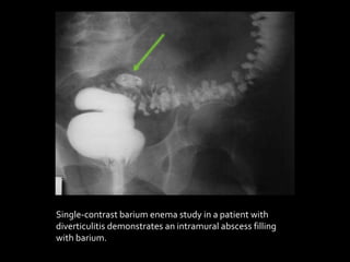 Diverticulitis X Ray