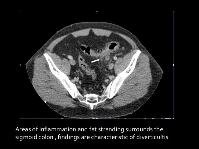 Imaging of Acute Diverticulitis