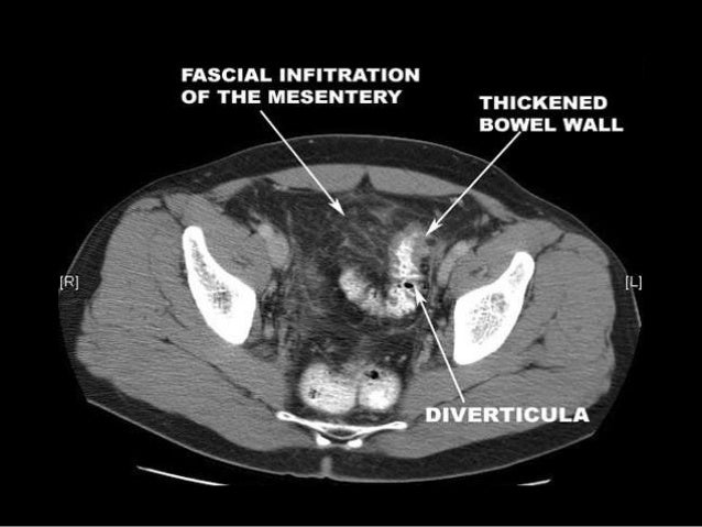 Imaging of Acute Diverticulitis