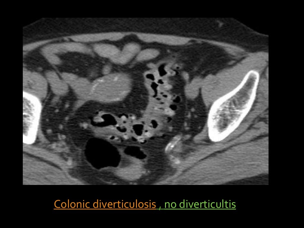 Imaging of Acute Diverticulitis