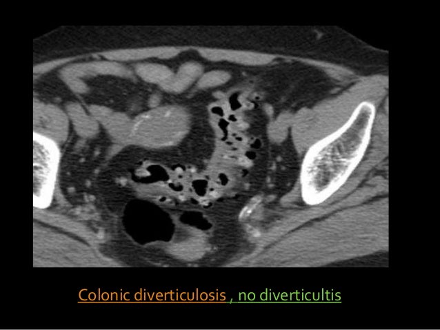 Imaging of Acute Diverticulitis