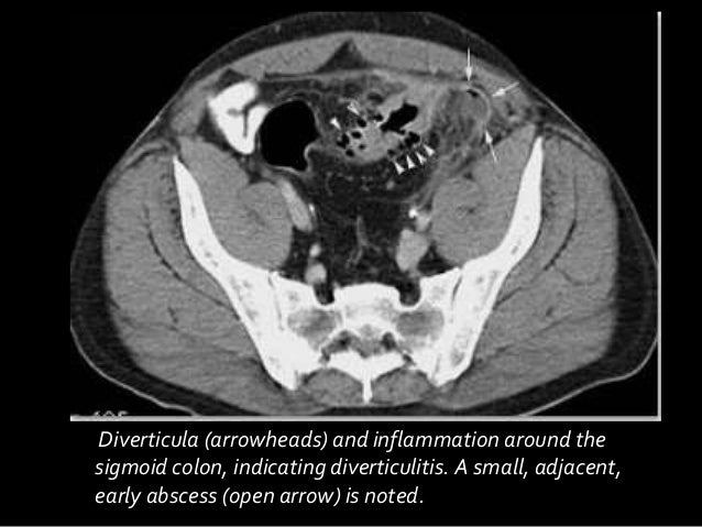 Imaging of Acute Diverticulitis