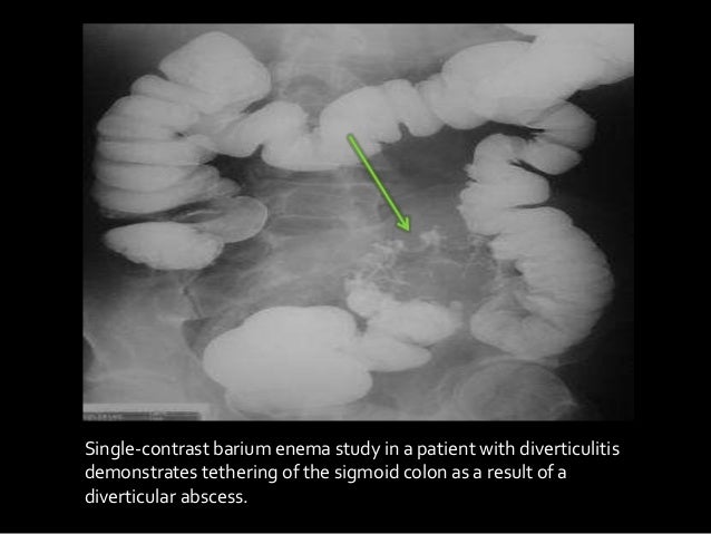Imaging of Acute Diverticulitis