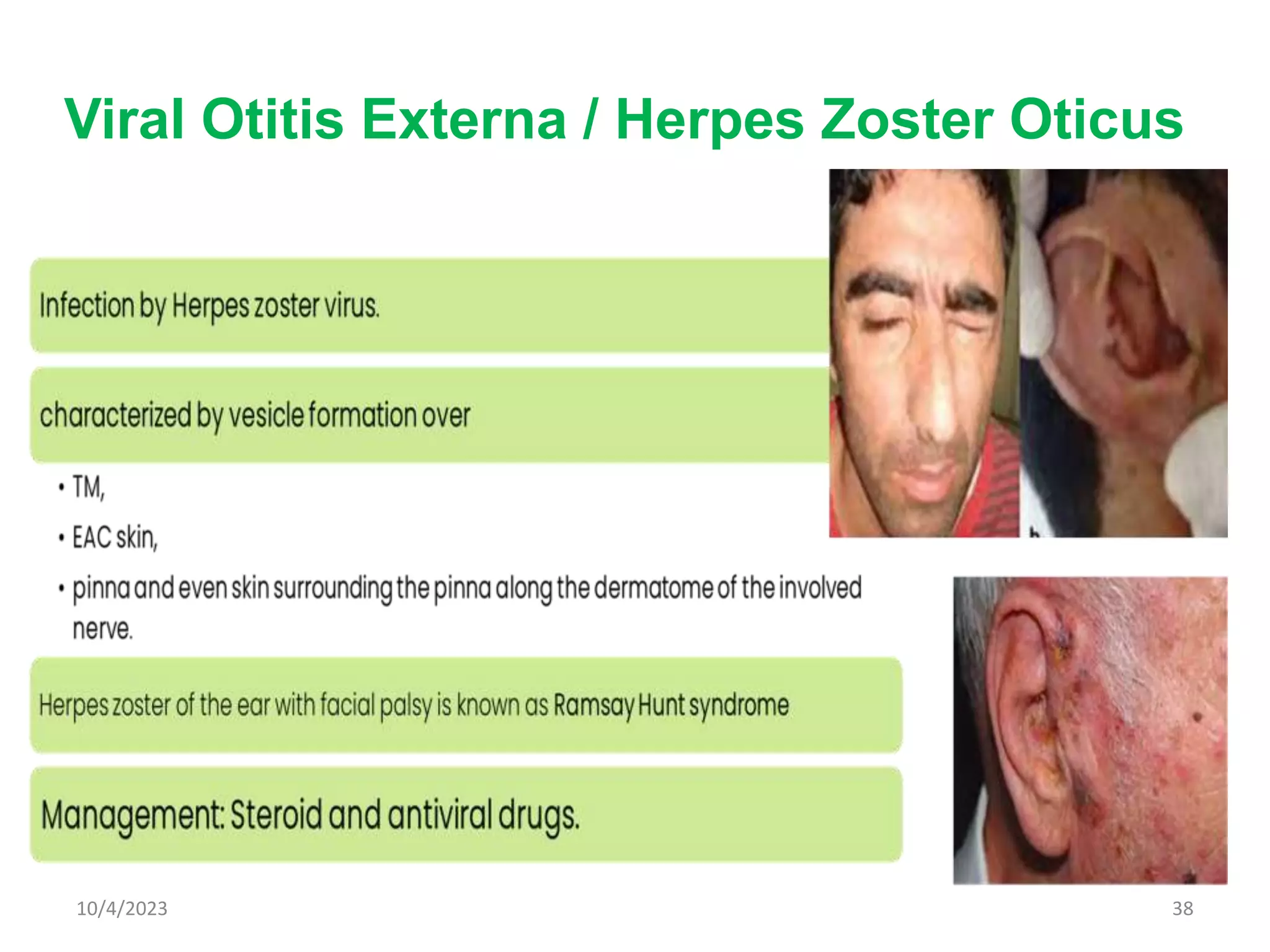 Acute Ear Problem.pptx