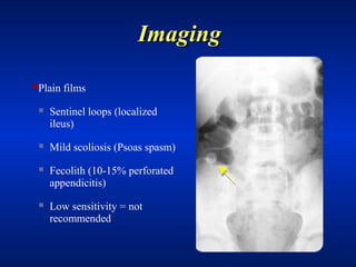 Sentinel Loop Appendicitis
