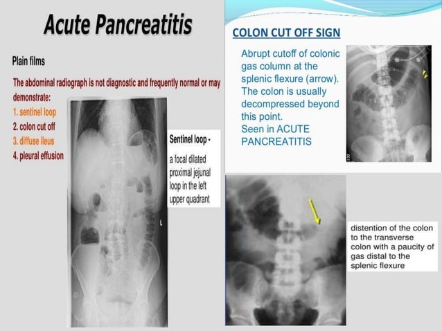 Acute epigastric pain | PPTX