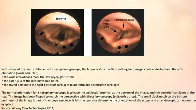 Acute epiglottitis