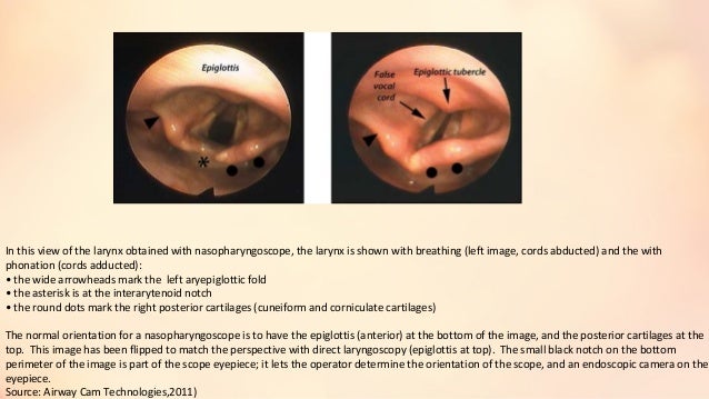 Acute epiglottitis