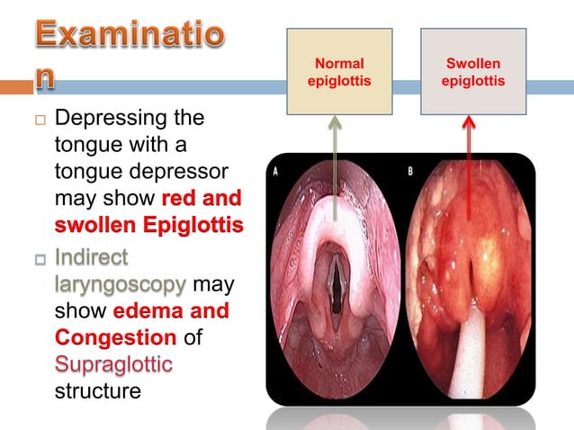 Acute epiglottitis | PPTX | Ear, Nose and Throat Conditions | Diseases and Conditions