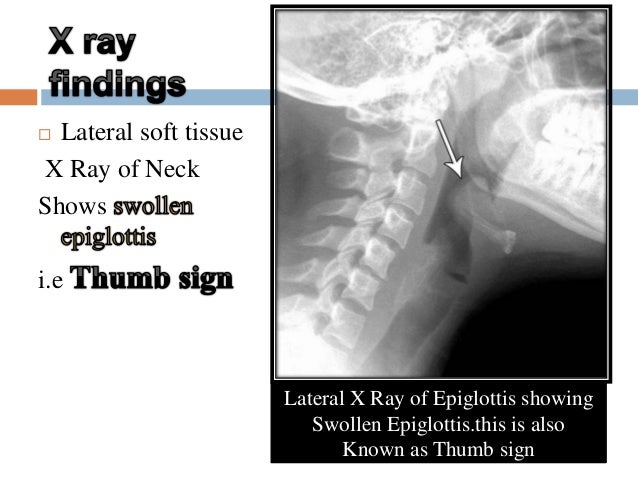 Normal Epiglottis