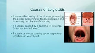 Acute epiglottitis by Joselyn | PPTX