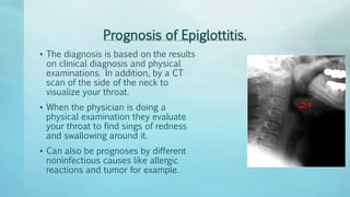 Acute epiglottitis by Joselyn | PPTX