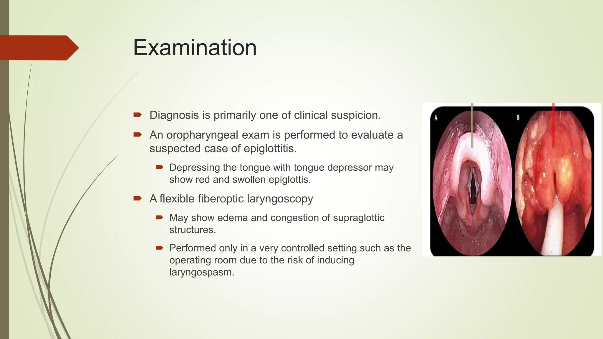 Acute epiglottitis | PPTX