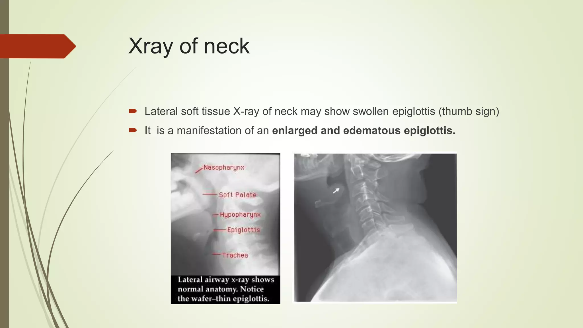 Acute epiglottitis | PPTX