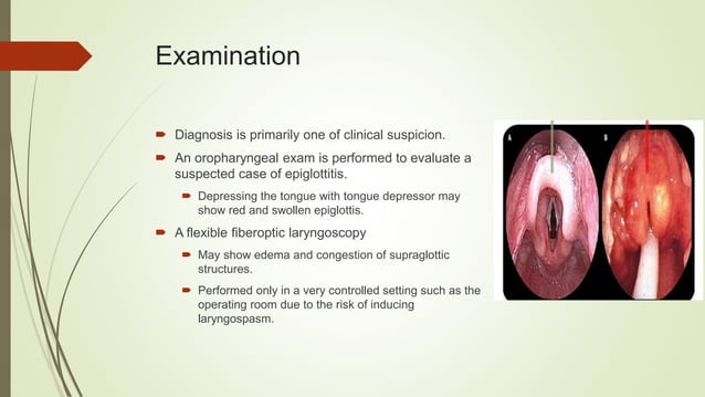 Acute epiglottitis | PPTX | Ear, Nose and Throat Conditions | Diseases ...