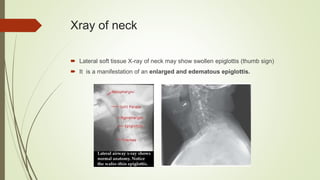 Thumb Sign Epiglottitis