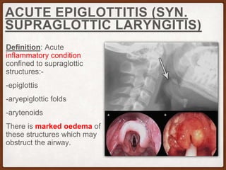 Acute Epiglottits (ppt) | PPTX