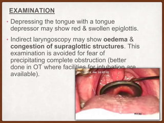Acute Epiglottits (ppt) | PPTX