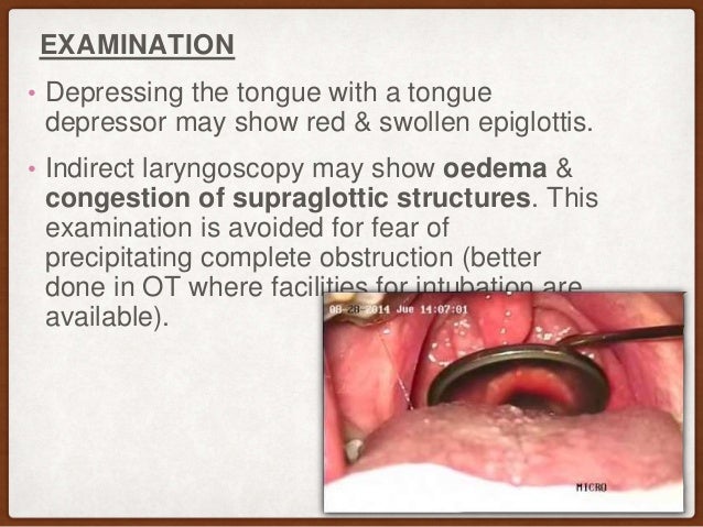 Acute Epiglottits (ppt)