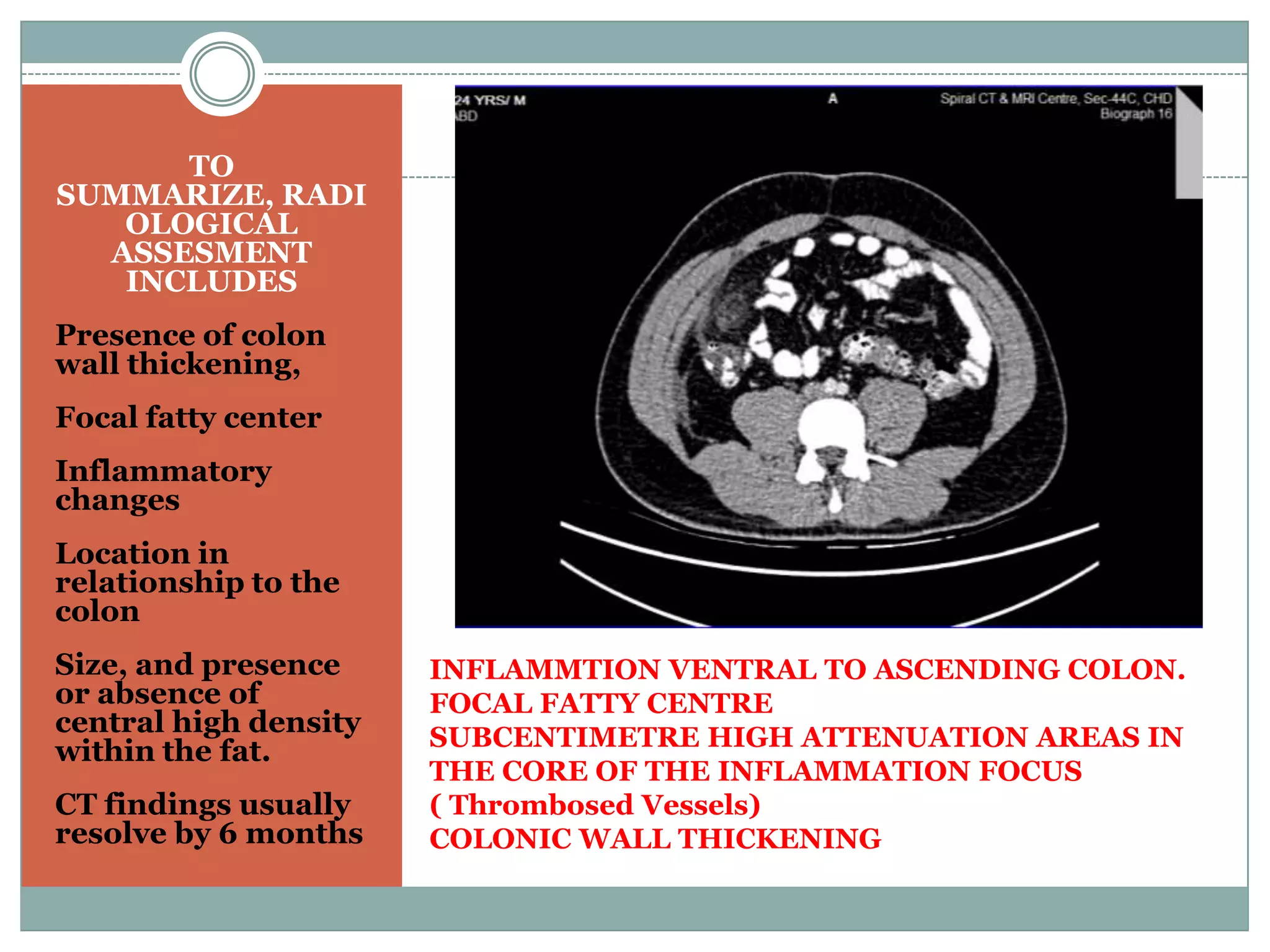 Acute epiploeic appendagitis.pptx2 | PPT