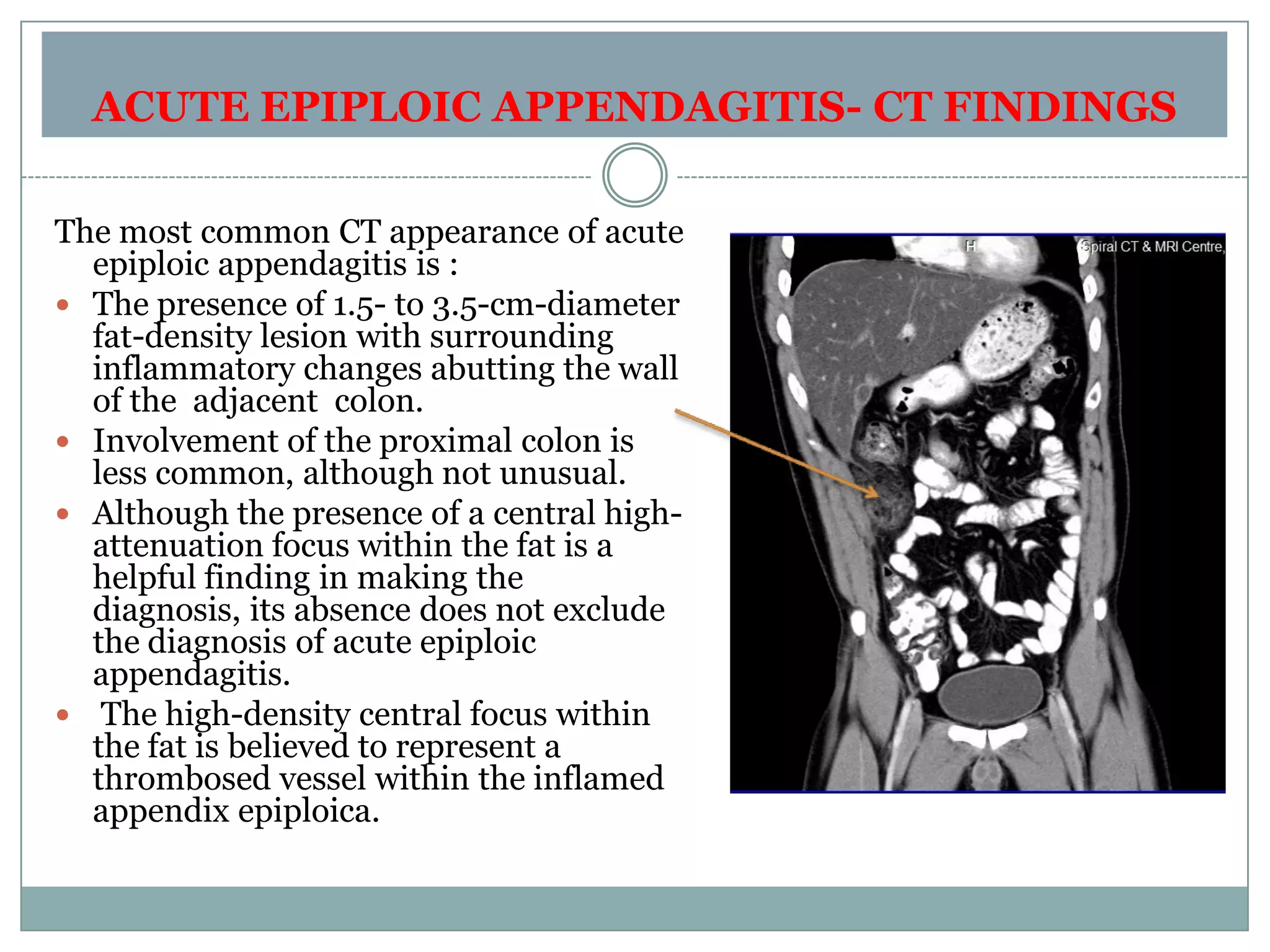 Acute epiploeic appendagitis.pptx2 | PPT